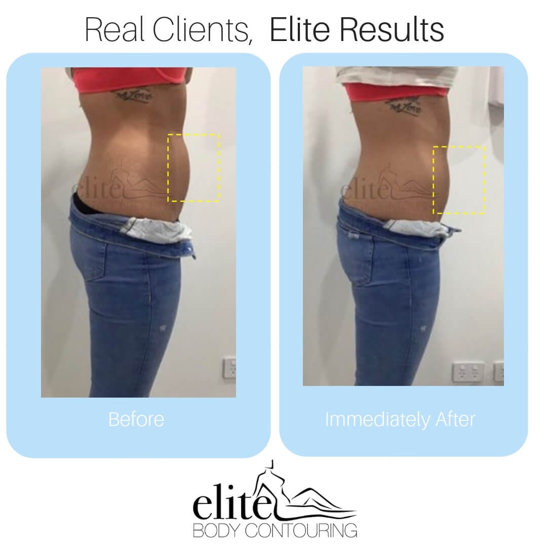 Client Results - Elite Body Contouring | Before and After Fat Freezing