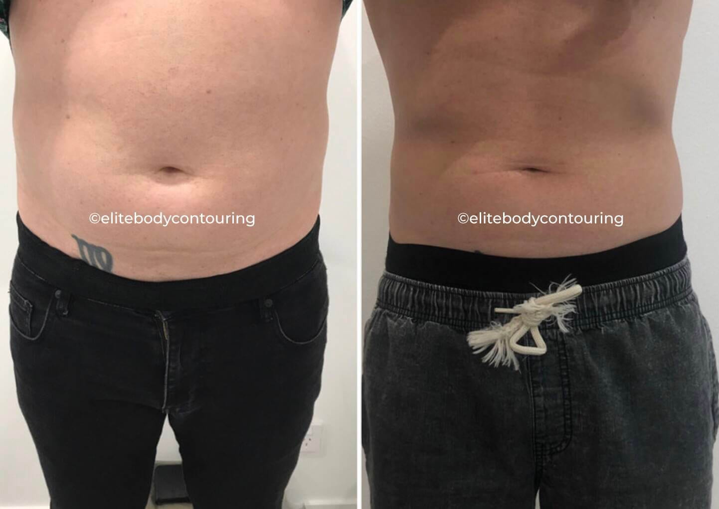 Client Results | Before & After | Elite Body Contouring