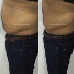 Client Results | Before & After | Elite Body Contouring