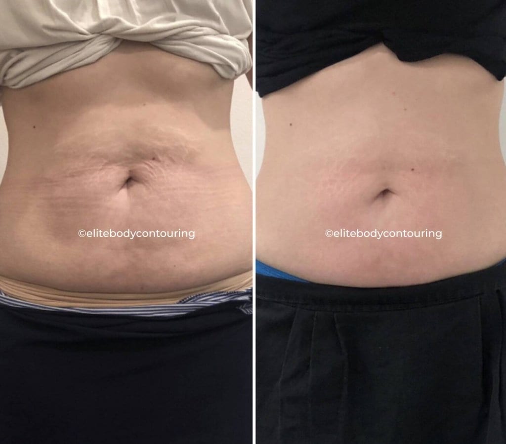 How To Tighten Skin | Best Way to Tighten Skin in Sydney