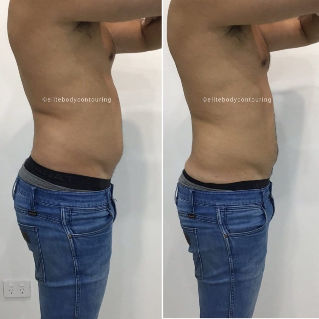 Client Results & Reviews | Elite Body Contouring