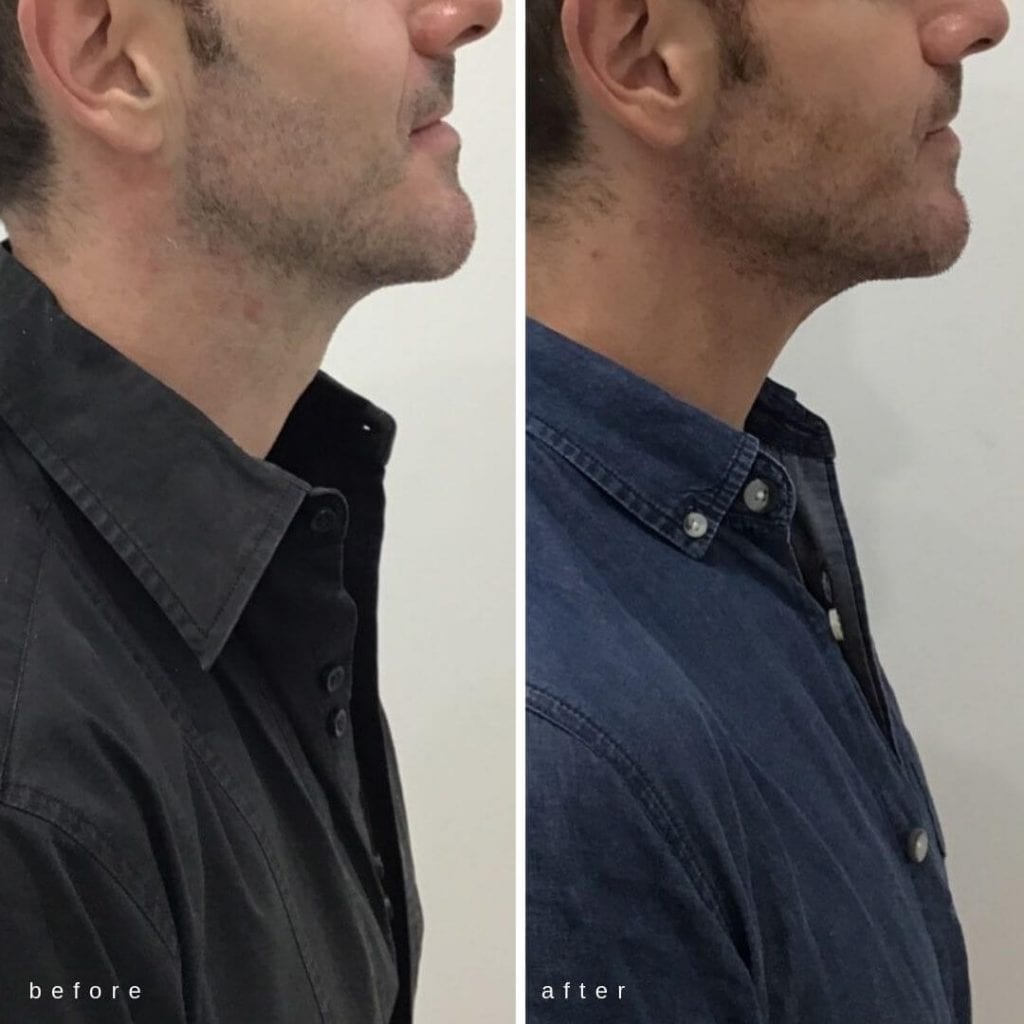 Chin Sculpting Reviews | Elite Body Contouring