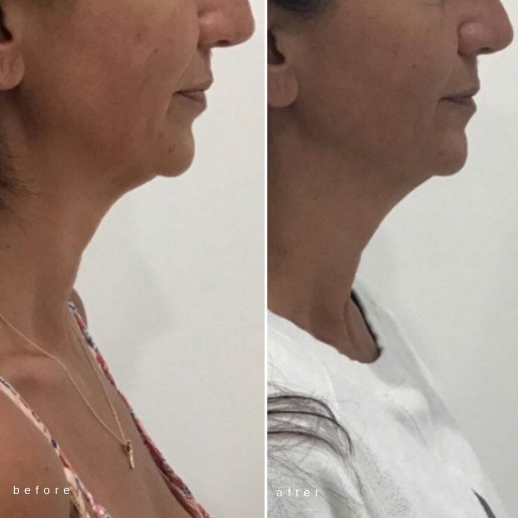 Chin Sculpting Reviews | Elite Body Contouring