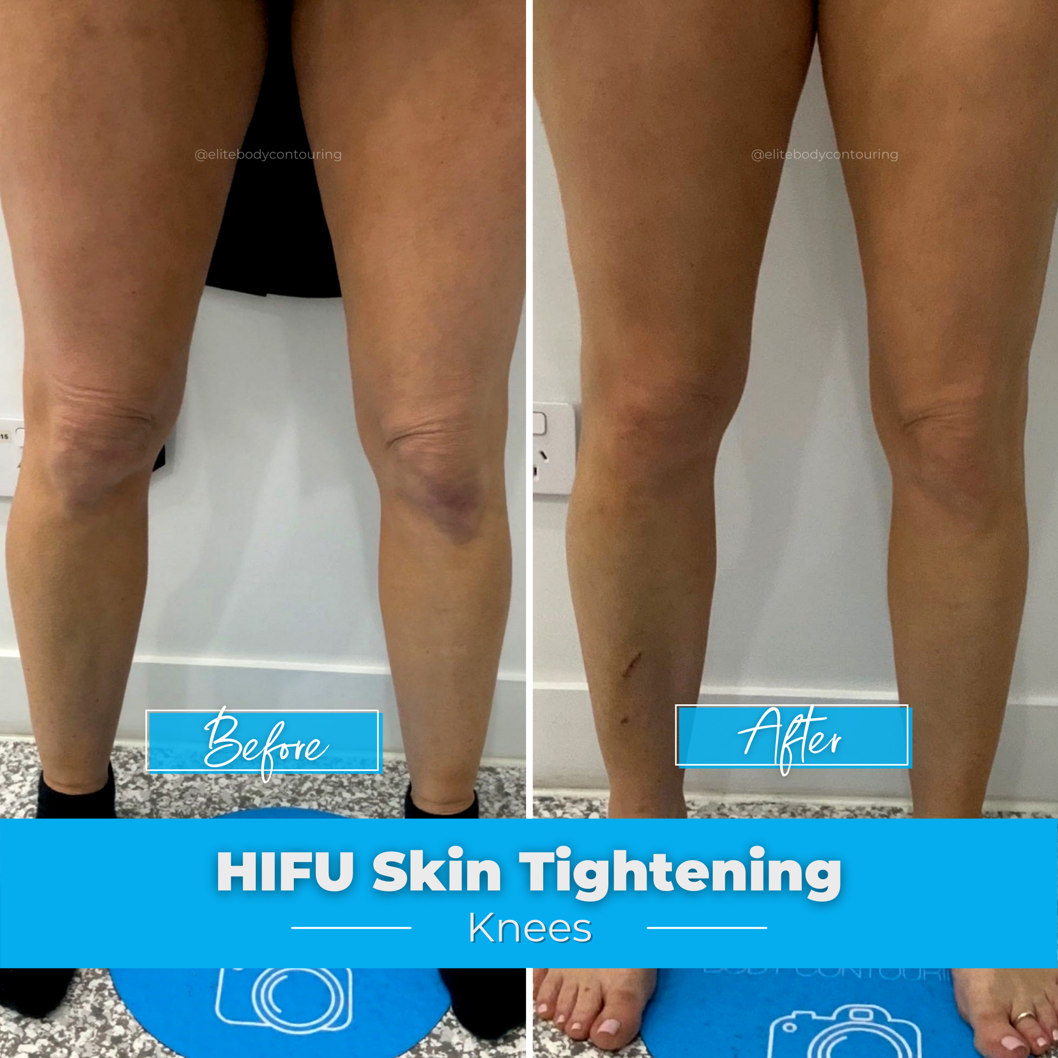 HIFU Non-Surgical Facelift Results | Elite Body Contouring