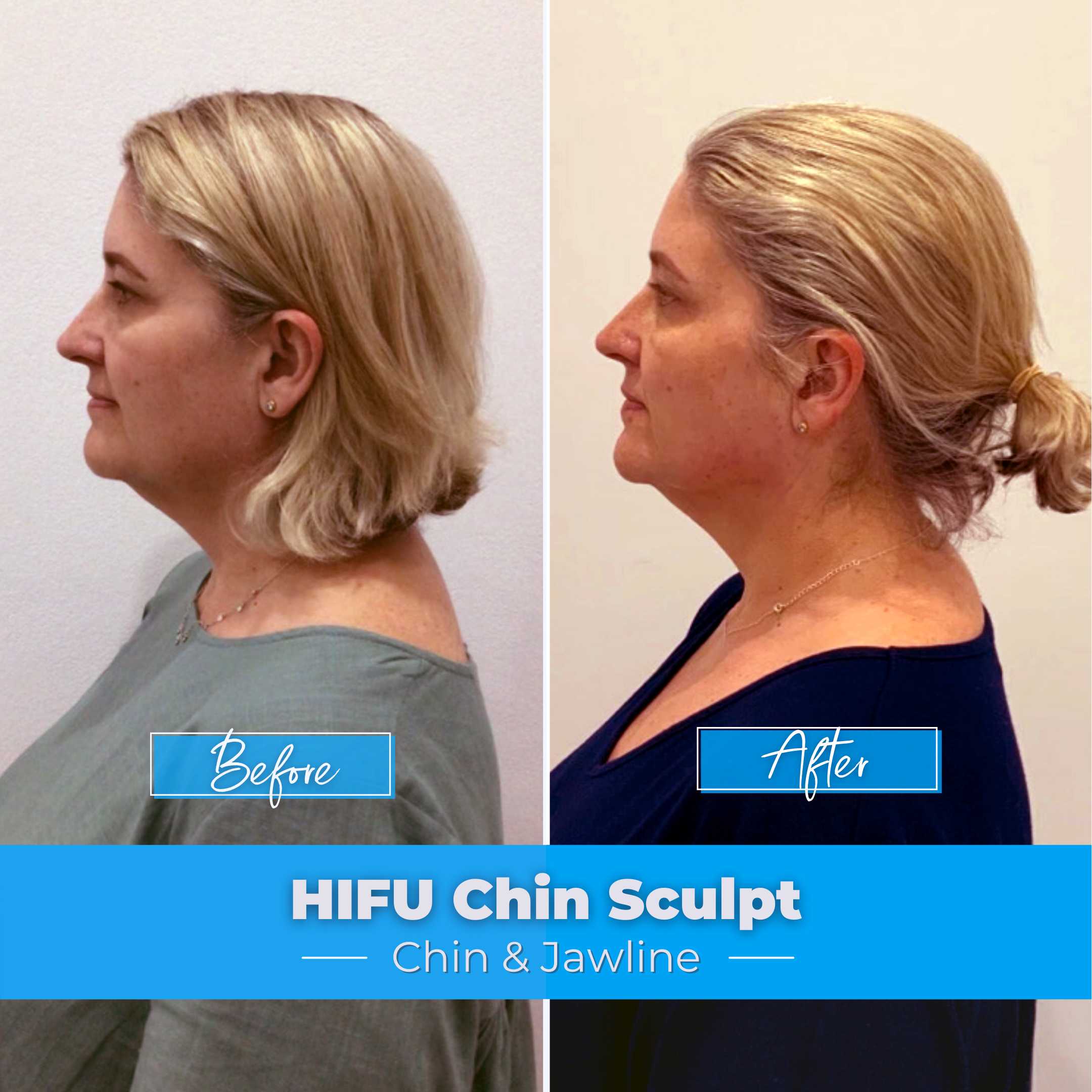 Chin Sculpting | HIFU | Double Chin | Elite Body Contouring