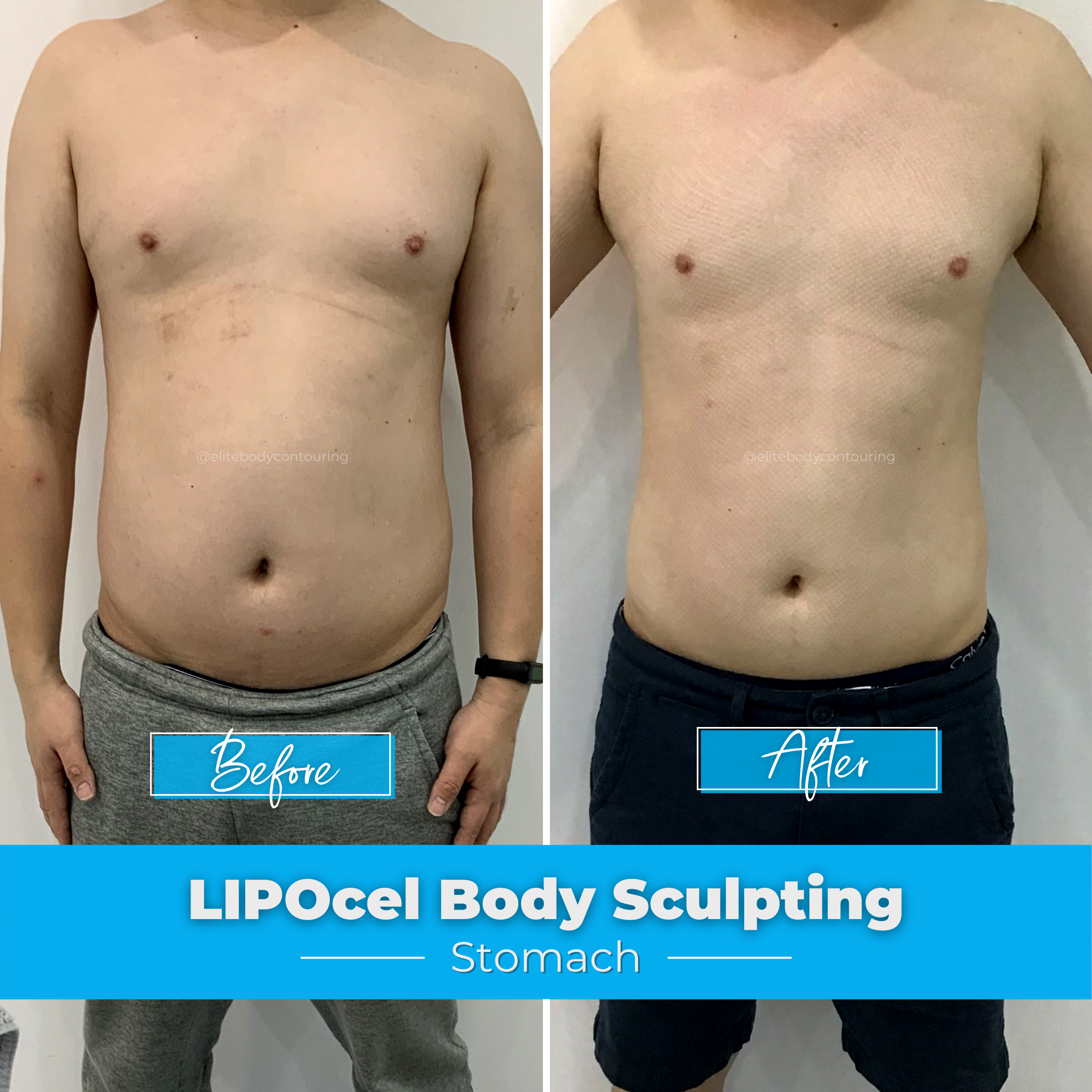 LIPOcel Body Sculpting Results | Elite Body Contouring