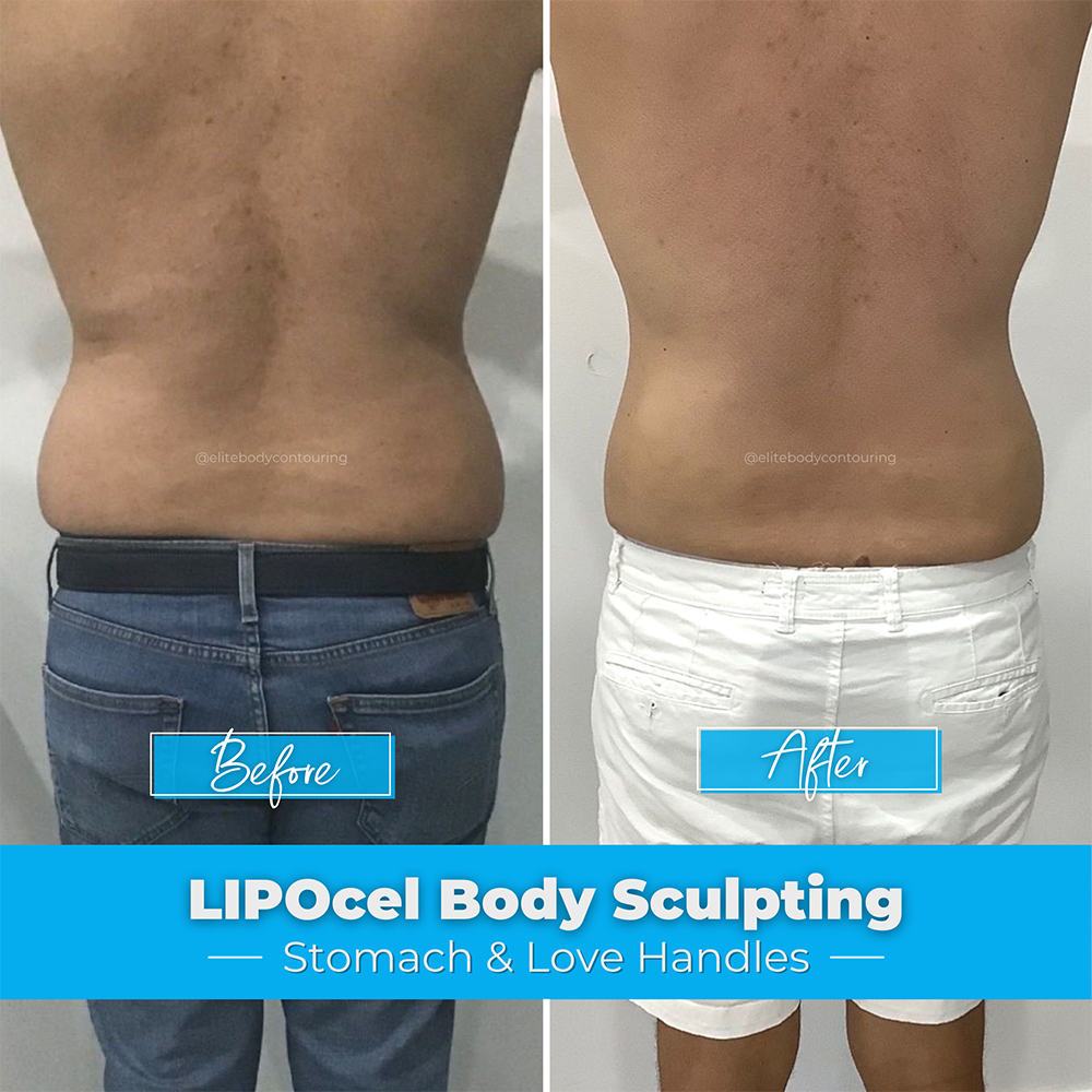 LIPOcel Body Sculpting Results | Elite Body Contouring