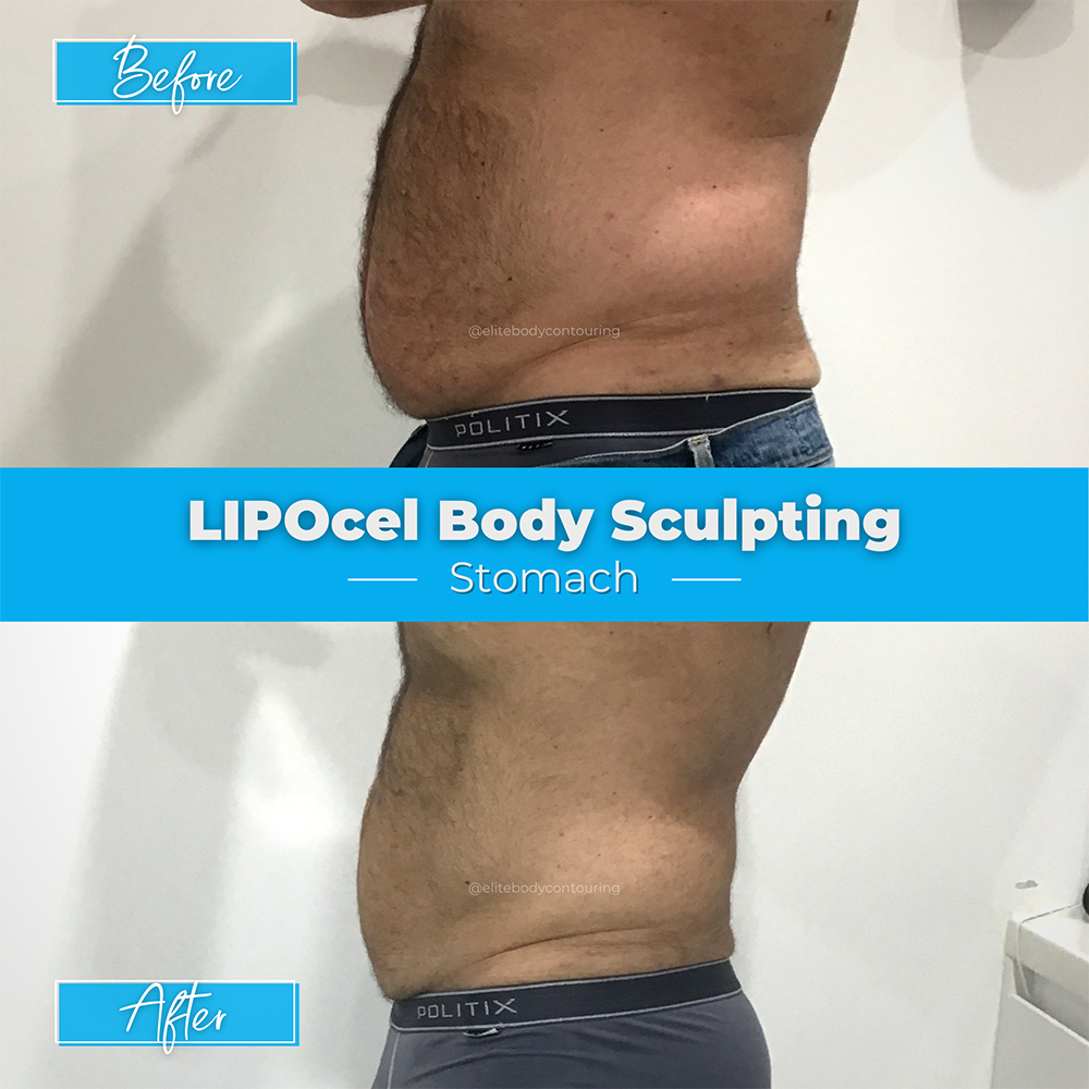 LIPOcel Body Sculpting Results | Elite Body Contouring