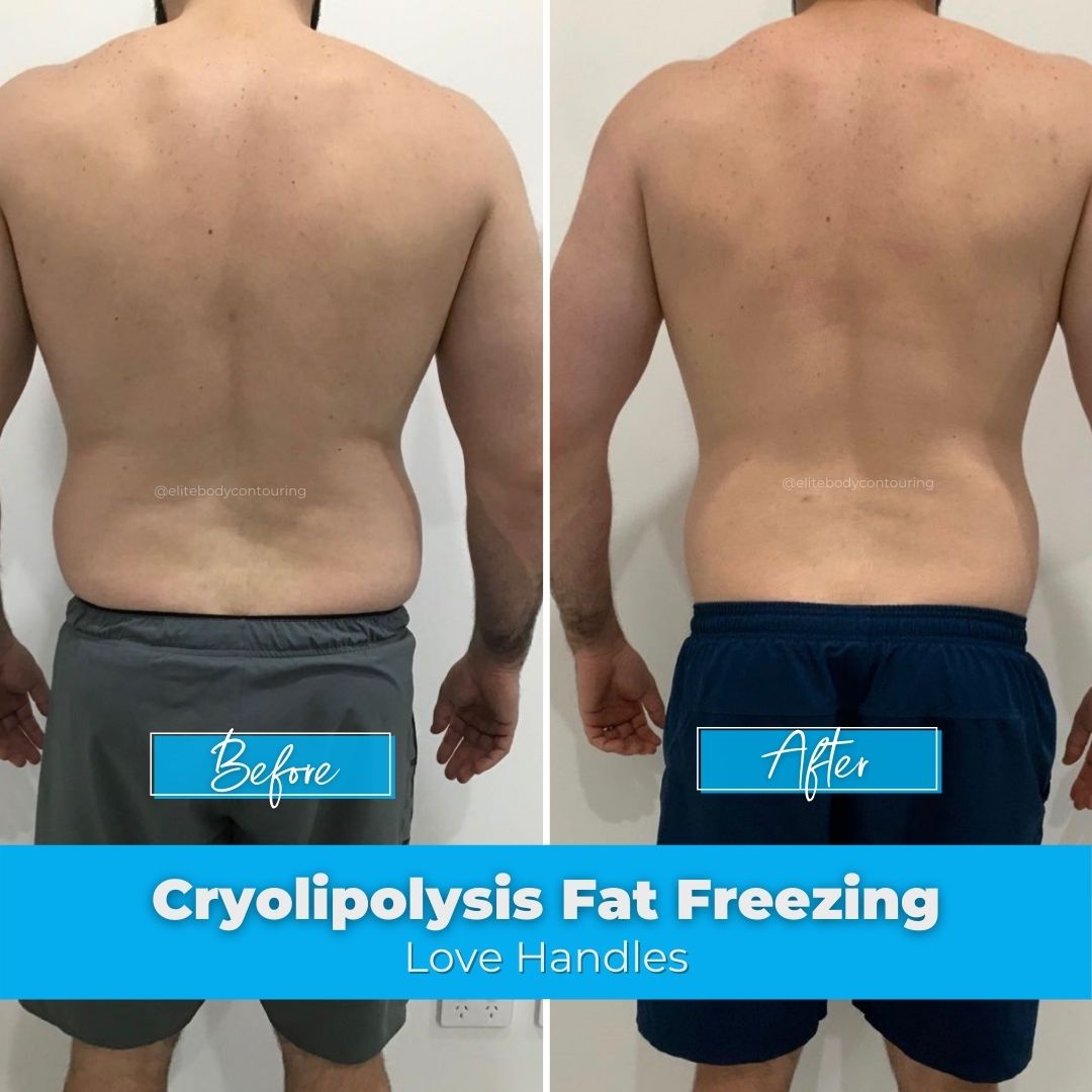 Fat Freezing Results | Elite Body Contouring