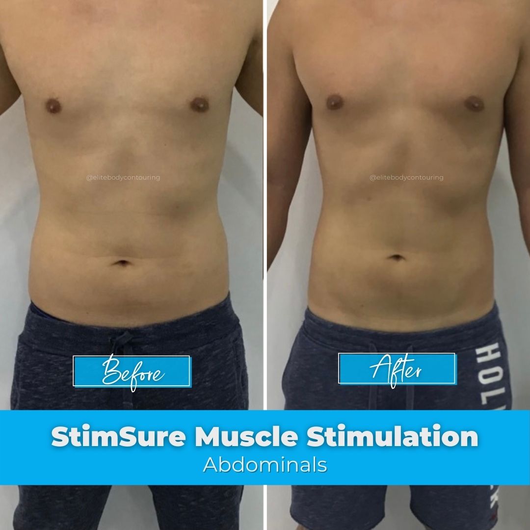 Stimsure Electromagnetic Muscle Stimulation | Elite Body Contouring