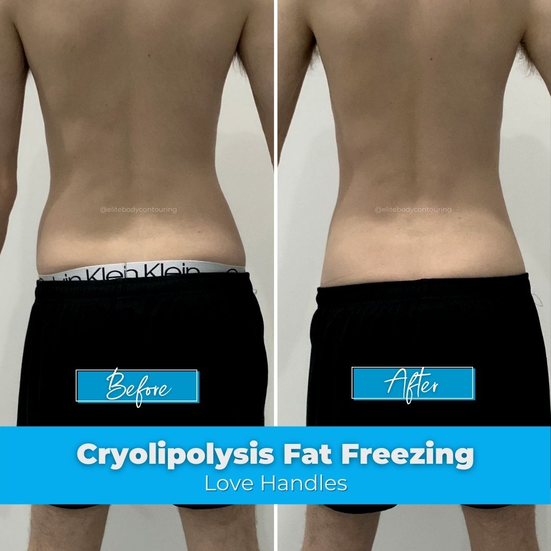 Fat Freezing Sydney | Cryolipolysis | Elite Body Contouring