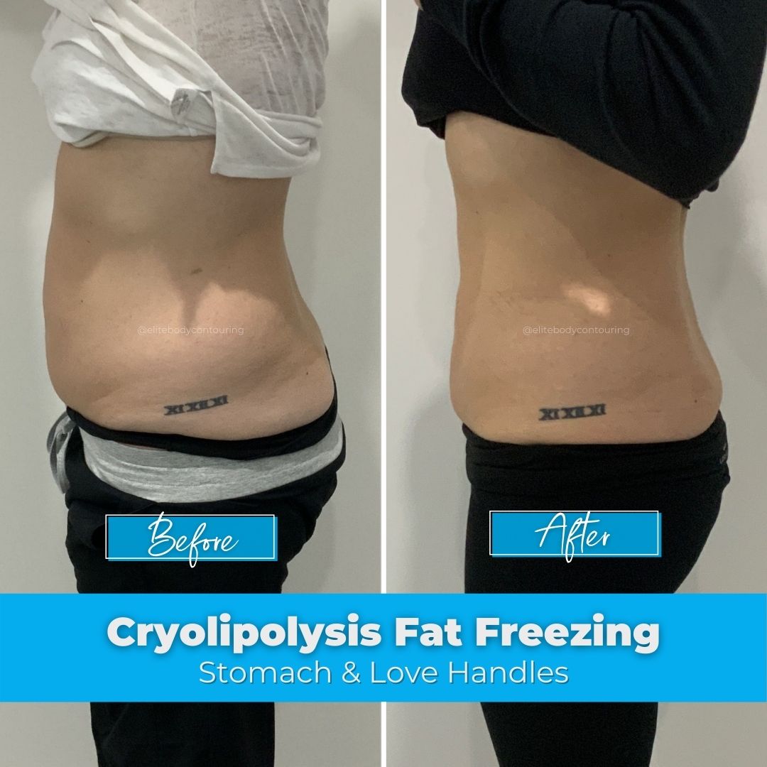 Fat Freezing Sydney | Cryolipolysis | Elite Body Contouring
