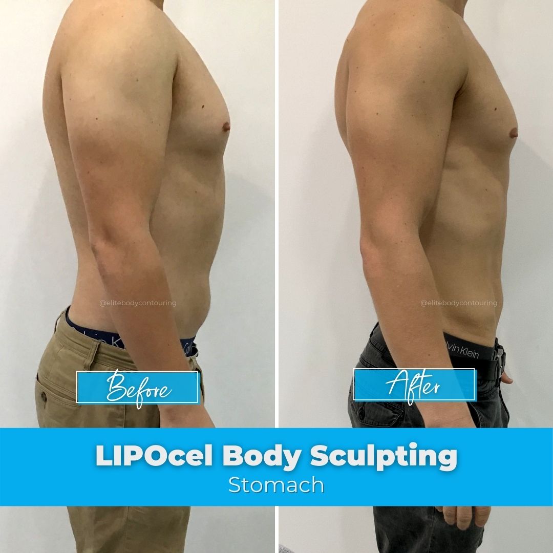 LIPOcel Body Sculpting | HIFU | Elite Body Contouring
