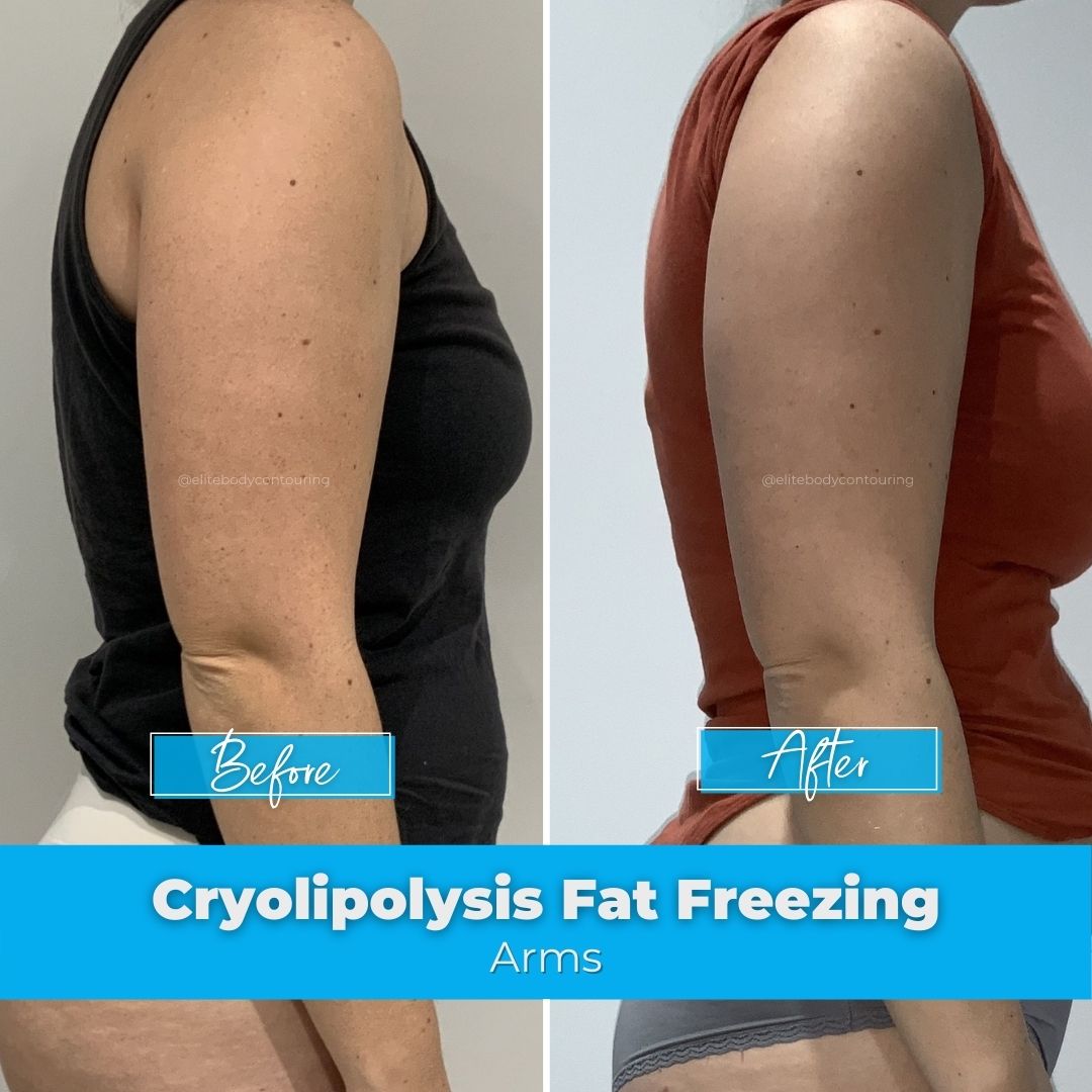 Fat Freezing Results | Elite Body Contouring