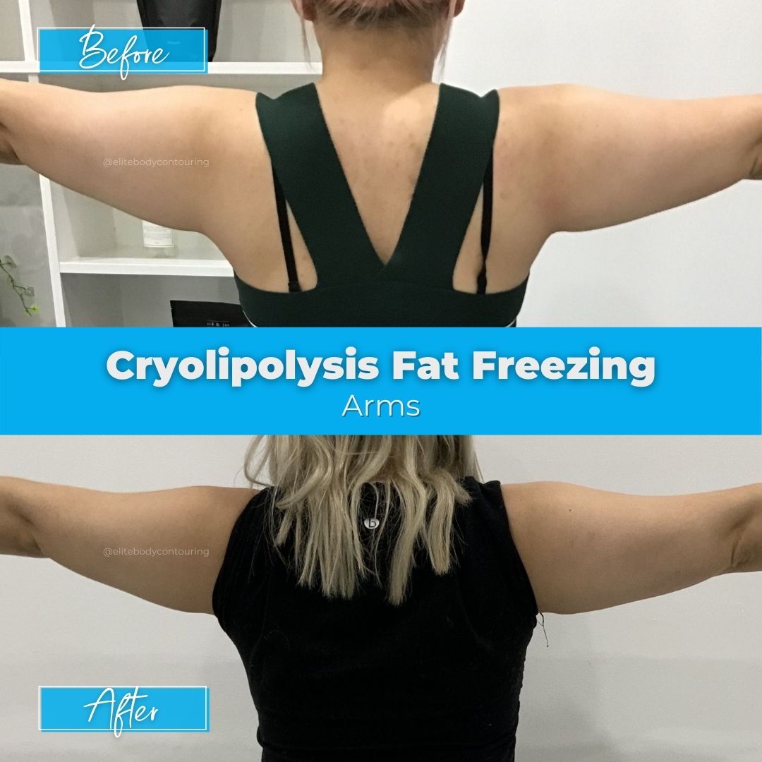 Fat Freezing Sydney | Cryolipolysis | Elite Body Contouring