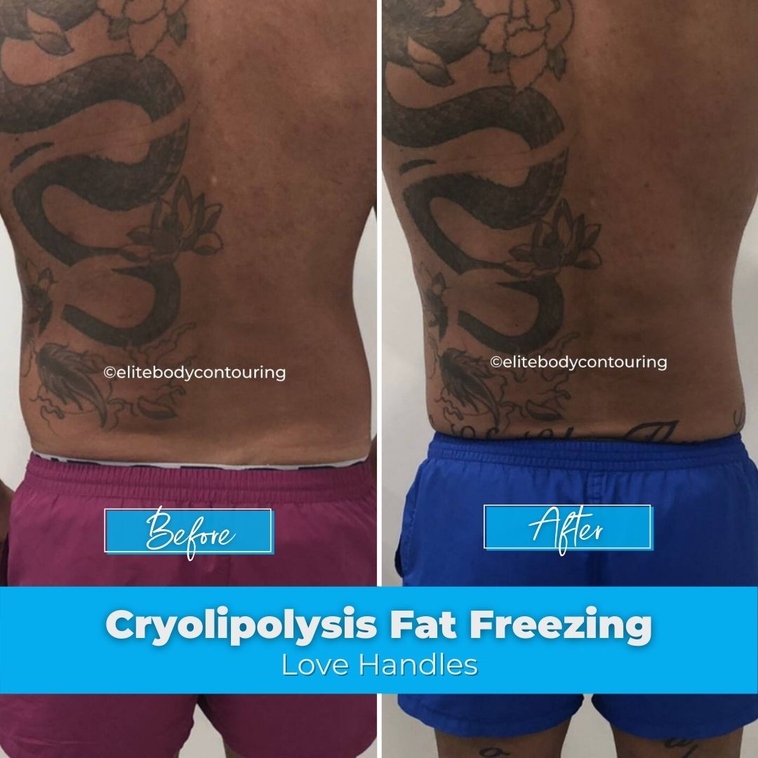 Fat Freezing Sydney | Cryolipolysis | Elite Body Contouring