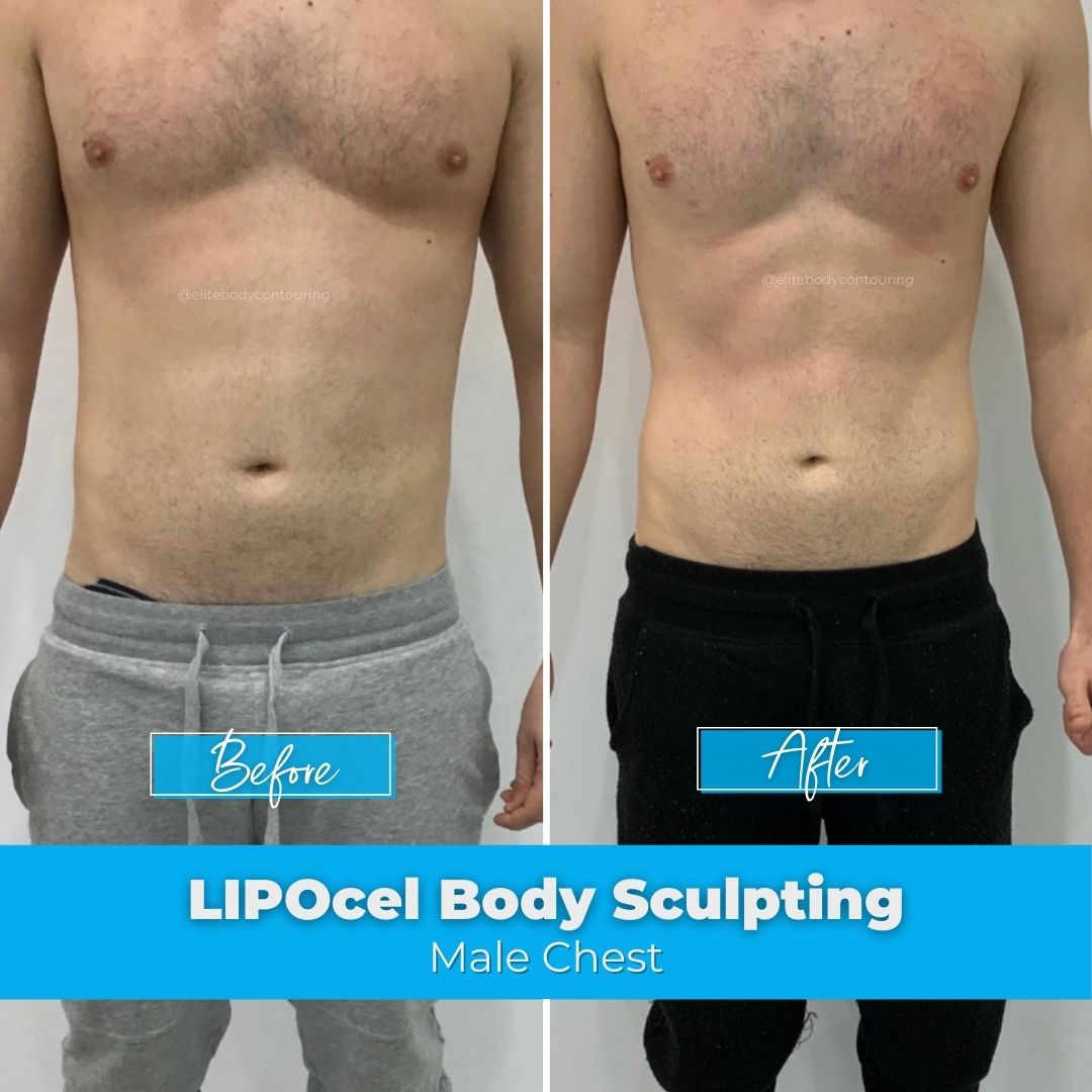 LIPOcel Body Sculpting | HIFU | Elite Body Contouring