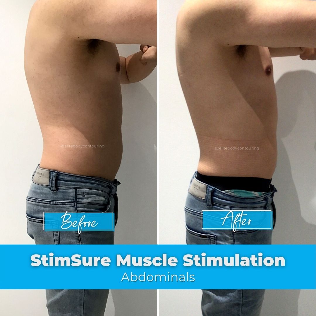 Stimsure Muscle Stimulation | Elite Body Contouring