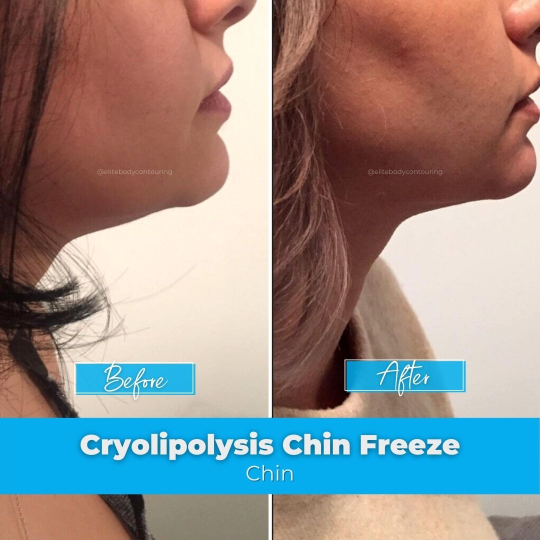 Fat Freezing Sydney | Cryolipolysis | Elite Body Contouring