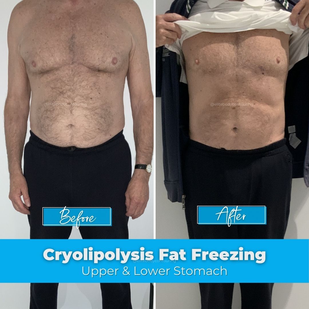 Fat Freezing Sydney | Cryolipolysis | Elite Body Contouring