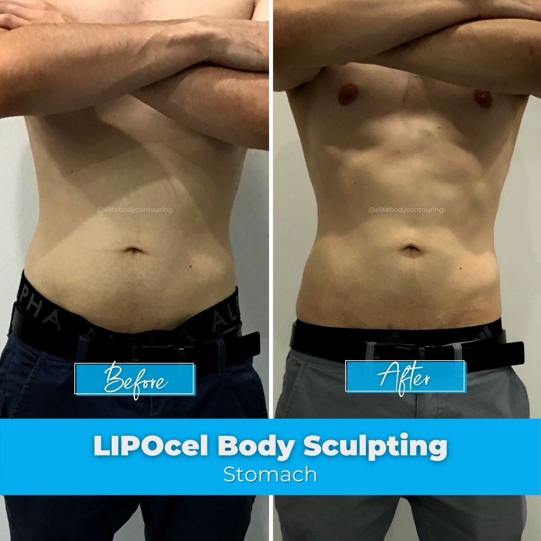 LIPOcel Body Sculpting | HIFU | Elite Body Contouring