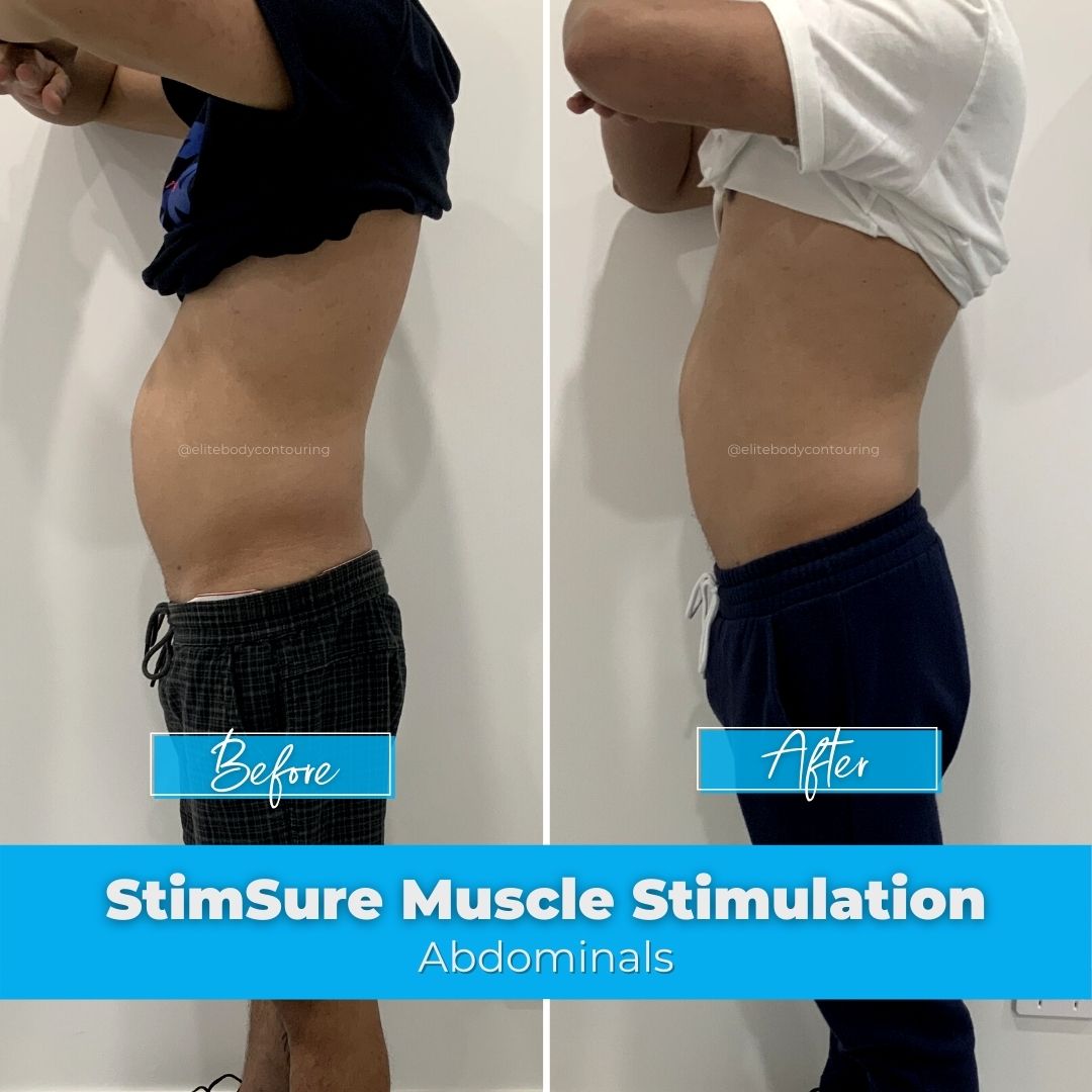 StimSure Muscle Stimulation Results | Elite Body Contouring