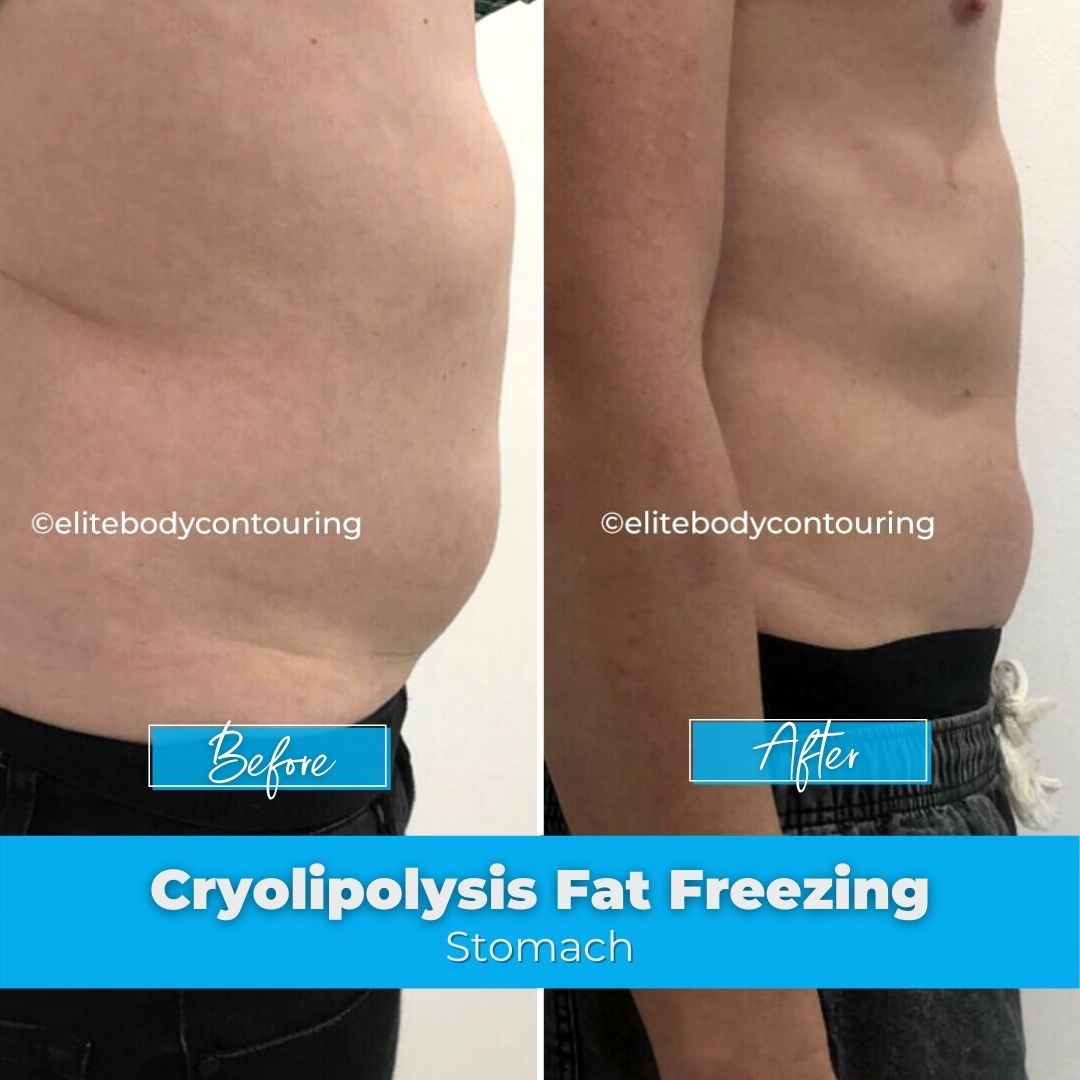Fat Freezing Sydney | Cryolipolysis | Elite Body Contouring