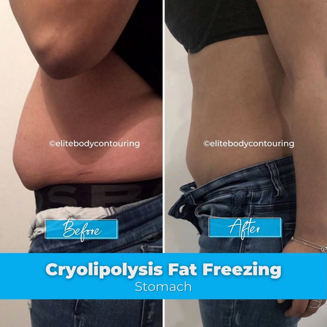 Fat Freezing Sydney | Cryolipolysis | Elite Body Contouring
