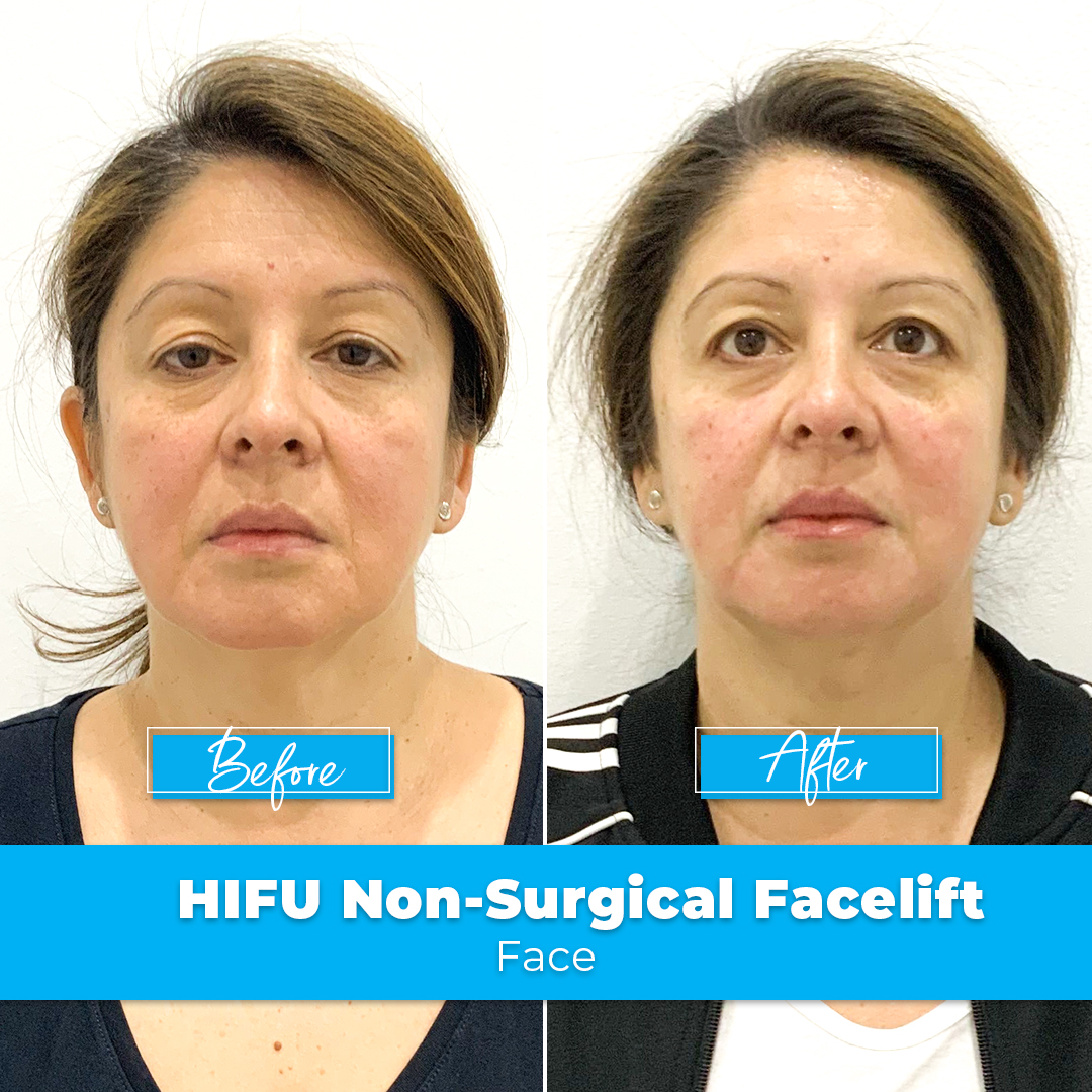 HIFU Non-Surgical Facelift Results | Elite Body Contouring