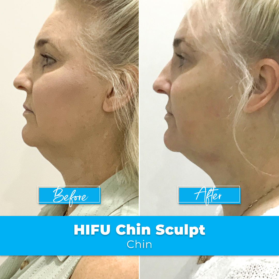 Chin Sculpting | HIFU | Double Chin | Elite Body Contouring