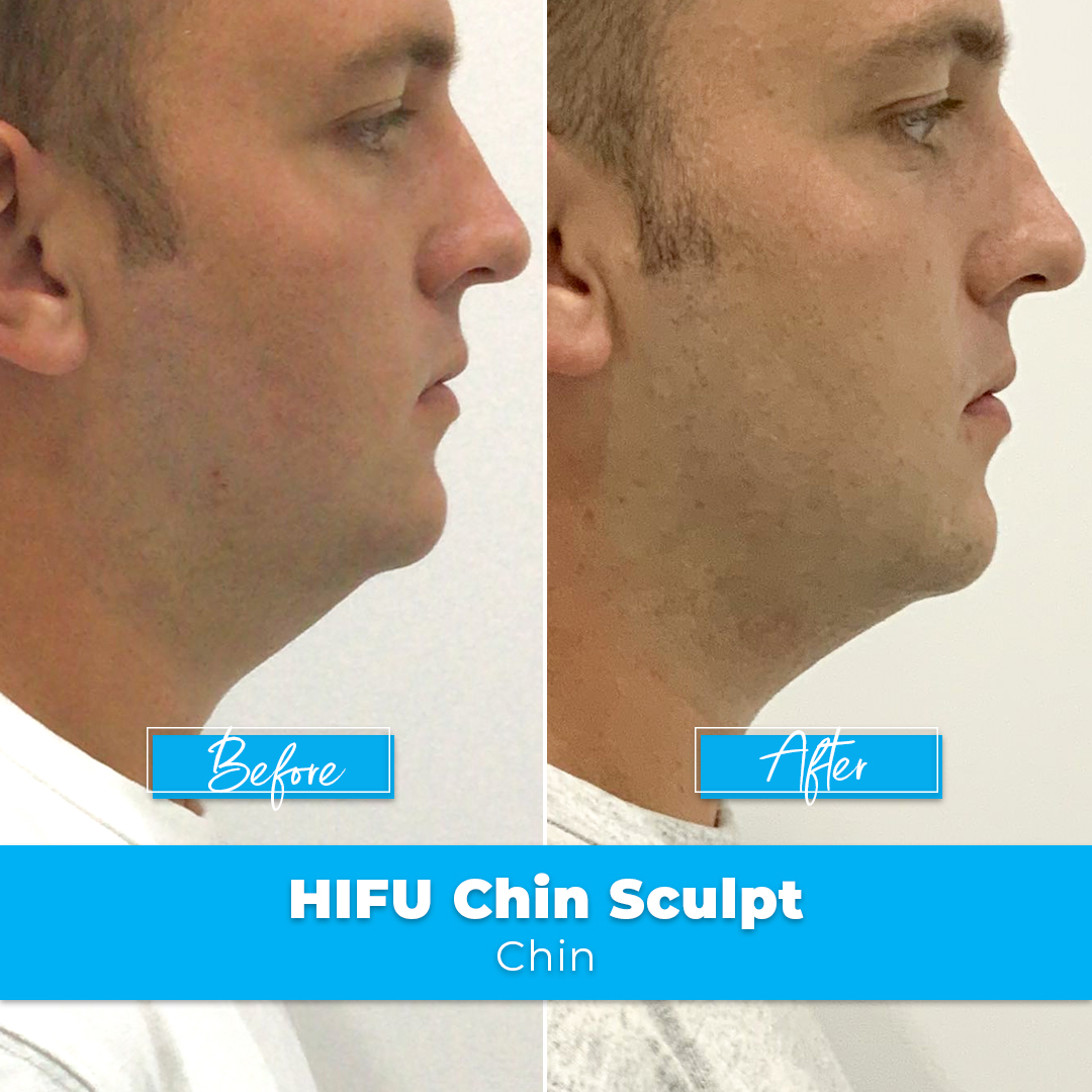 Chin Sculpting | HIFU | Double Chin | Elite Body Contouring