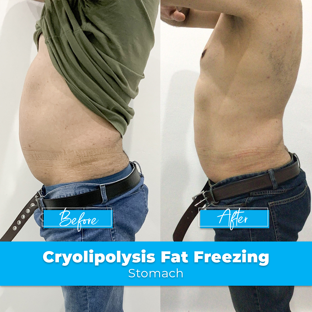 Fat Freezing Results | Elite Body Contouring