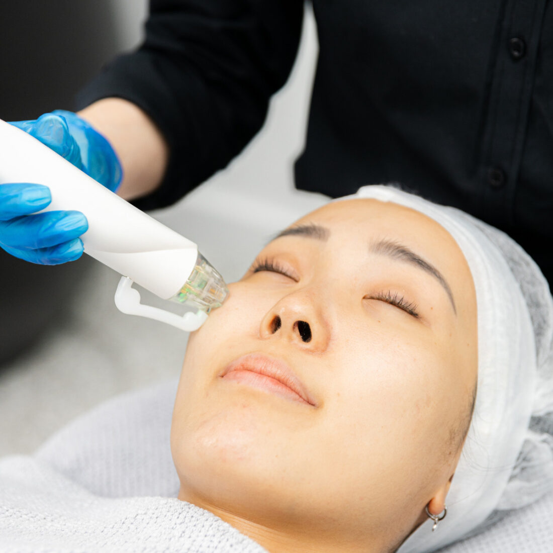 RF Microneedling - Elite Body Contouring