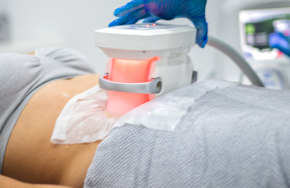 Freezing Liposuction Procedures